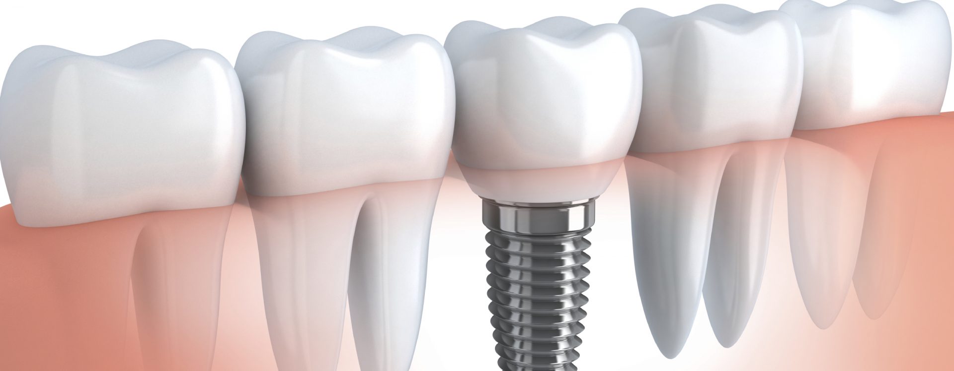 Perio and Surgery - Cambie Marine Gateway Dental